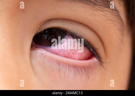 Macro of a very red eye with oriental features due to conjunctivitis ...
