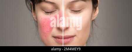 Before and after acneiform rosacea treatment. Red pimple cheek of a ...