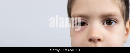 Eye of a child with conjunctivitis, inflammation of the conjunctiva ...