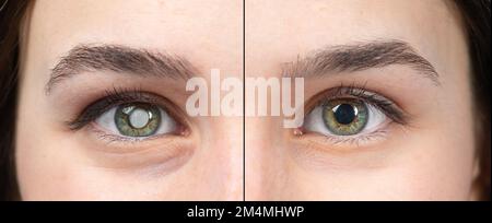Vision simulation before and after cataract removal from a patient with ...