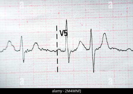 ECG ElectroCardioGraph paper that shows Normal Sinus Rhythm NSR with ...