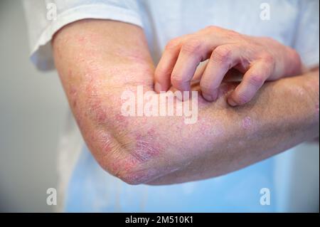 Itchy psoriasis on arm and hand Stock Photo - Alamy