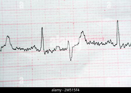 ECG ElectroCardioGraph paper that shows Normal Sinus Rhythm NSR with ...