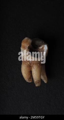Tooth decay on black background. Macro shot of a decayed teeth till ...