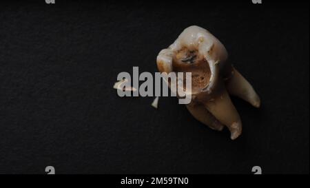 Tooth decay on black background. Macro shot of a decayed teeth till ...