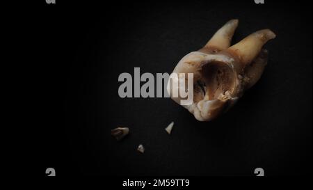 Tooth decay on black background. Macro shot of a decayed teeth till ...