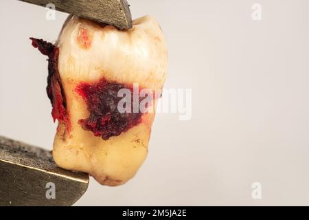 Human wisdom tooth inside a dental tool. Dentistry concept. Macro photo ...