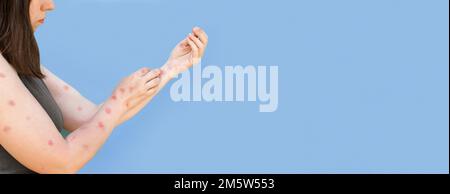 Monkeypox new disease dangerous over the world. Patient with Monkey Pox ...