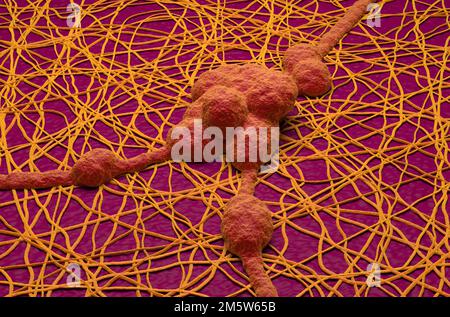 Nerve cells in multiple sclerosis. Computer illustration showing the ...