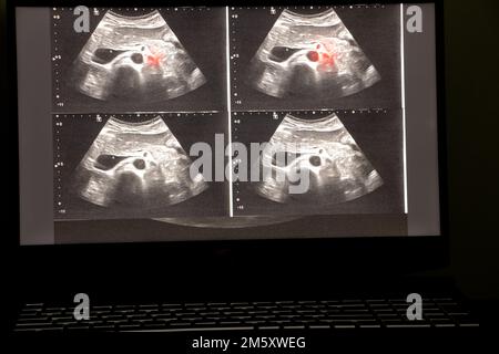 Ultrasound of a woman's abdomen on a laptop screen monitor in a doctor ...
