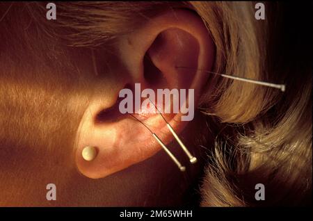 Acupuncture needles in a woman's ear and back. This traditional Chinese ...