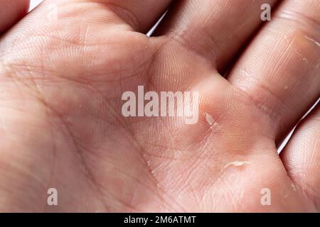 Hand with blister and callus close up Stock Photo - Alamy