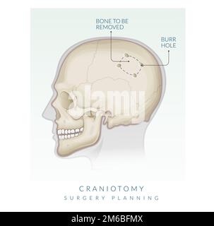 Craniotomy Surgery - Bone Flap Removal - Stock Illustration as EPS 10 ...