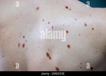 Melanocytic nevus, some of them dyplastic or atypical, on a caucasian ...