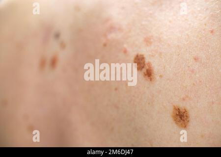 Melanocytic nevus, some of them dyplastic or atypical, on a caucasian ...