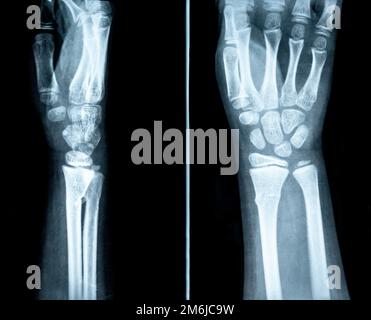 Right hand two positions check roentgenogram black background Stock ...