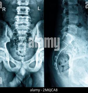 Pelvic bones two positions check roentgenogram black background Stock ...
