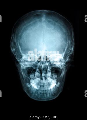 X-ray image of Human Skull Front view for diagnosis skull fracture ...