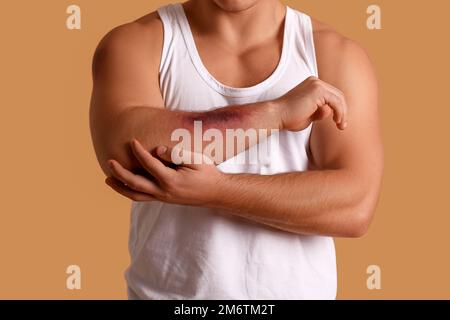 Male arm with bruise on beige background Stock Photo - Alamy