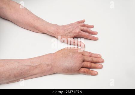 Post-Operative Swollen Dupuytren's Contracture Right Hand with sutures ...