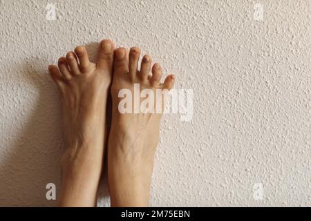 Person feet with subungual hematoma, black toenails caused by trauma ...