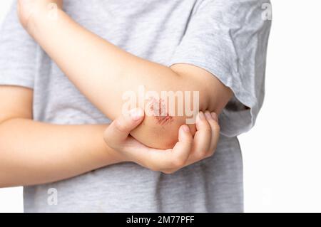 Children injury. Deep scratches on the skin on the kids knee. Wounds ...