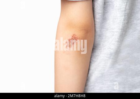Wounds, scratches and abrasions on skin of child leg. Children injury ...