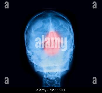 xray film of a skull of a patient (paranasal sinus) with acute right ...