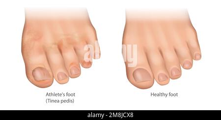 psoriasis,injury,bacteria,skin,body,arm,virus,chronic,microbe,allergy ...