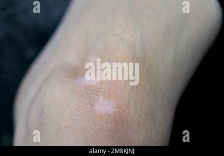 Close-up of several white vitiligo skin patches in the right armpit of ...