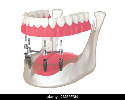 3d render of bar retained removable overdenture installation supported ...