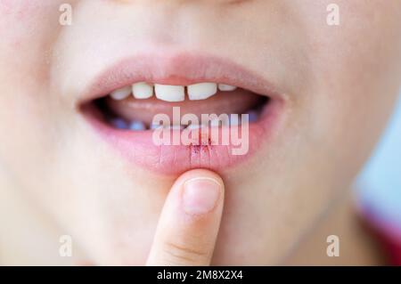 Child have Aphthous ulcer or Canker sore on mouth at lip Stock Photo ...