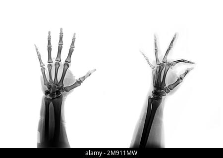 film x-ray Hand AP/Oblique : show normal human's hand Stock Photo - Alamy