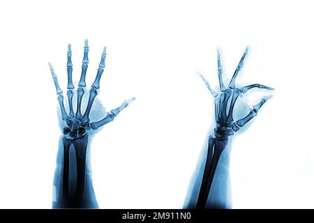 film x-ray Hand AP/Oblique : show normal human's hand Stock Photo - Alamy