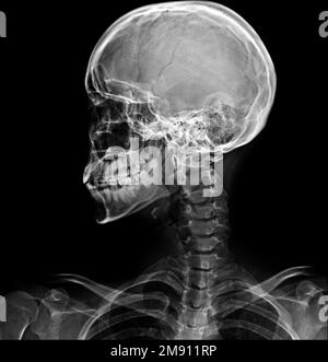 lateral skull x-ray Stock Photo - Alamy