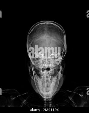 X-ray of brain and skull skeleton. Headache, meningitis and migraine ...