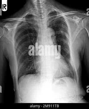 Film chest x-ray show interstitial infiltration both lung Stock Photo ...
