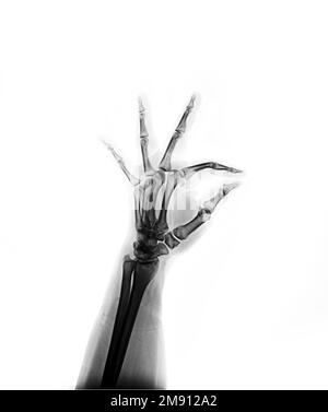 X-ray hand AP view normal Stock Photo - Alamy