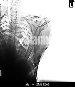 Film x-ray clavicle AP show fracture clavicle bone Stock Photo - Alamy