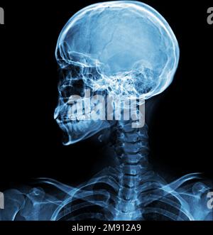 Skull lateral view x ray Stock Photo - Alamy