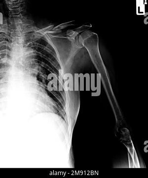 Film x-ray clavicle AP show fracture clavicle bone Stock Photo - Alamy