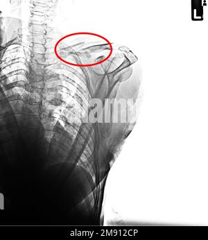 Film x-ray clavicle AP show fracture clavicle bone Stock Photo - Alamy