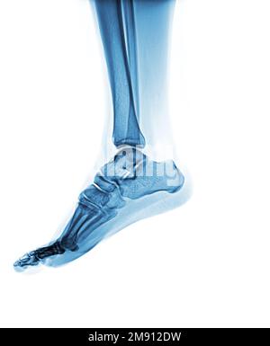 X-ray normal human foot . Lateral view Stock Photo - Alamy