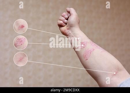 Man with sick arm, dry flaky skin on his hand with vulgar psoriasis ...