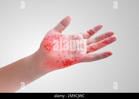 Hand, foot & mouth disease. Skin lesions on the hand of a four year-old ...