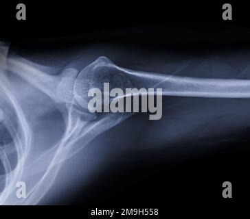 X-ray Shoulder joint shoulder transaxillary view for diagnosis fracture ...