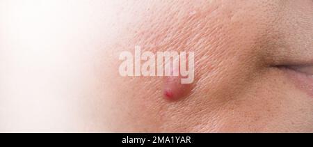 Bacterial skin infection. Big Acne Cyst Abscess or Ulcer Swollen area ...