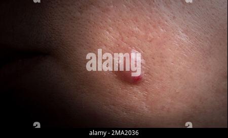Bacterial skin infection. Big Acne Cyst Abscess or Ulcer Swollen area ...