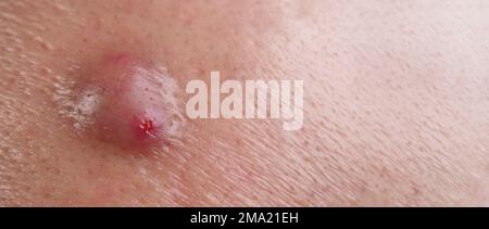 Bacterial skin infection. Big Acne Cyst Abscess or Ulcer Swollen area ...