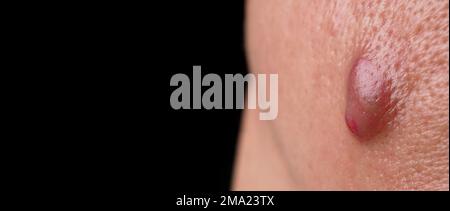 Bacterial skin infection. Big Acne Cyst Abscess or Ulcer Swollen area ...